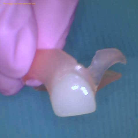 What a Flipper Tooth Looks Like - 1311 Jackson Ave Dental | Dentist in ...