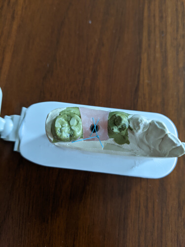 How Many Stitches Will I Get After a Tooth Extraction - 1311 Jackson ...