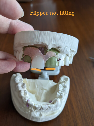 Wearing a Flipper Tooth With a Healing Abutment - 1311 Jackson Ave ...