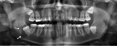 Why Wisdom Teeth Swell Up And What To Do About It