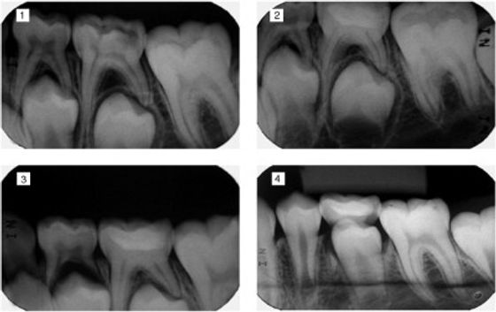 How To Pull Out a Tooth - Complete Guide - 1311 Jackson Ave Dental ...