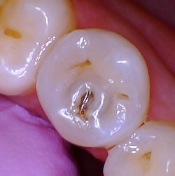 Options For a Broken Wisdom Tooth
