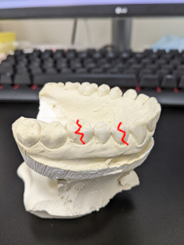 Tooth Split In Half Vertically: What To Do - 1311 Jackson Ave Dental ...