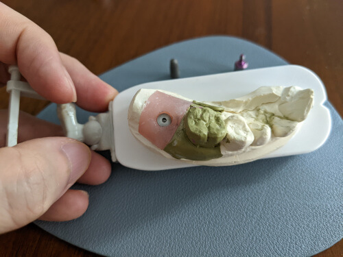 Healing Abutment vs Cover Screw: Implant Part Differences - 1311 ...