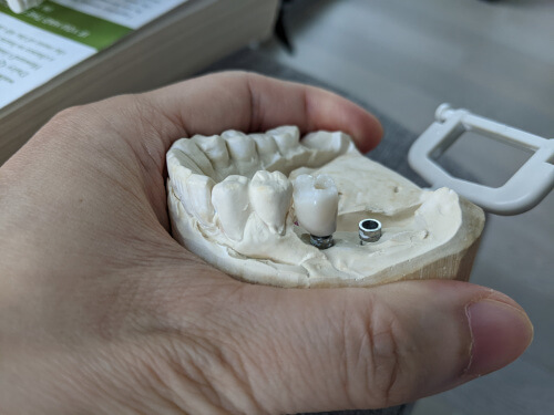 Signs & Symptoms of a Bad Fitting Crown - 1311 Jackson Ave Dental ...