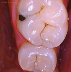 How to Differentiate a Cavity From a Stain - 1311 Jackson Ave Dental ...