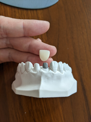 Crown With Post: Things To Know - 1311 Jackson Ave Dental | Dentist in ...