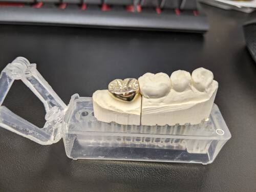 Gold Tooth Crown: Things To Know - 1311 Jackson Ave Dental | Dentist in ...