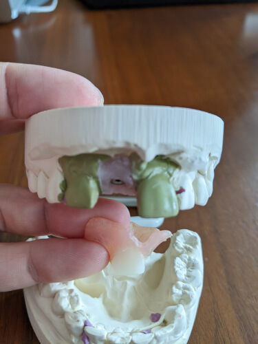 Wearing a Flipper Tooth With a Healing Abutment - 1311 Jackson Ave ...