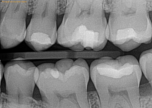 Dental X-rays: Things To Know - 1311 Jackson Ave Dental | Dentist in ...