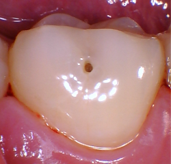 What Does A Cavity Look Like?