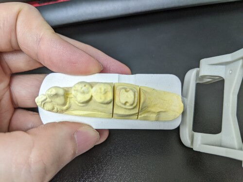 Signs & Symptoms of a Bad Fitting Crown - 1311 Jackson Ave Dental ...