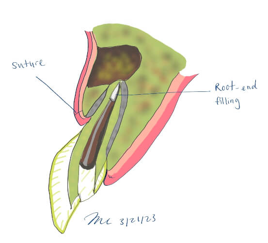 Apicoectomy Dental Procedure: Things To Know - 1311 Jackson Ave Dental ...