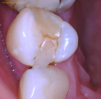 Dental Filling Long Island City | Dental Bonding | Cavity Filling ...