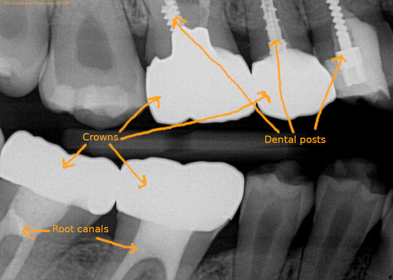 Permanent Crown Fell Out With Post Attached: Causes & Treatment - 1311 ...