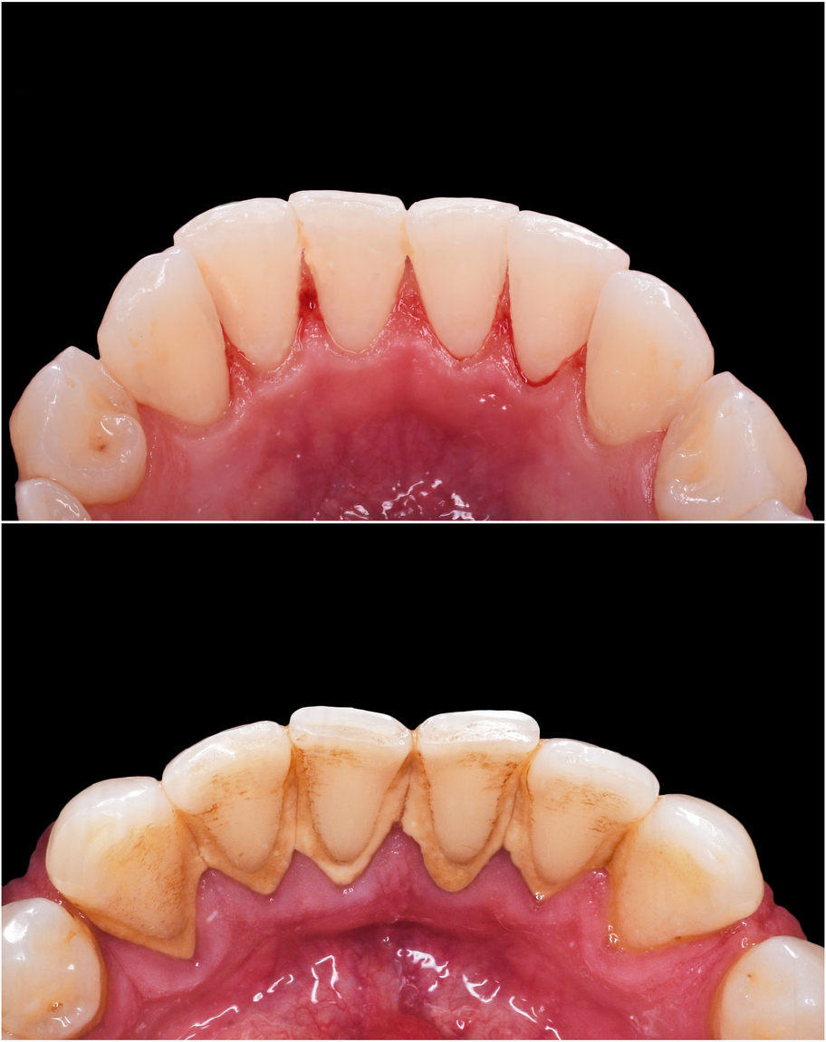 What Happens During a Dental Checkup: Demystifying Expectations - 1311 ...