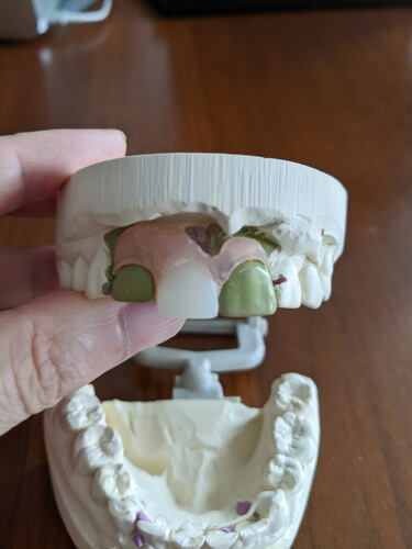 Wearing a Flipper Tooth With a Healing Abutment - 1311 Jackson Ave ...