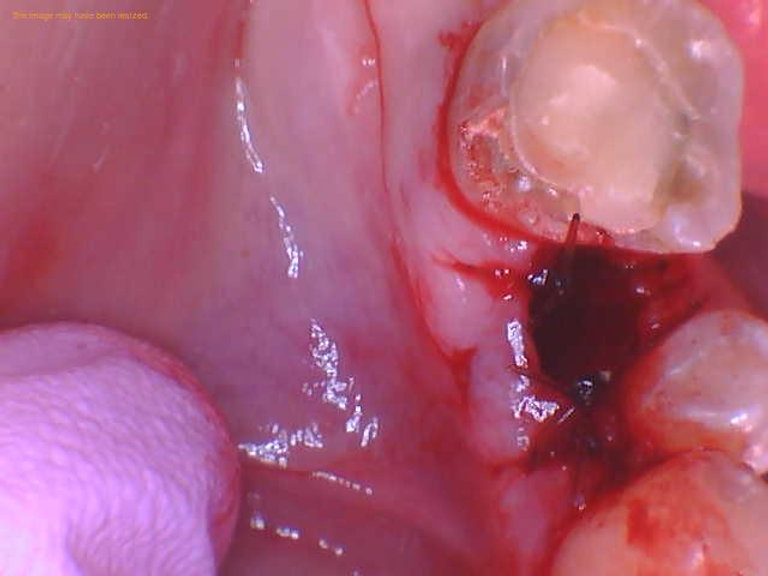 wisdom tooth removal gone wrong