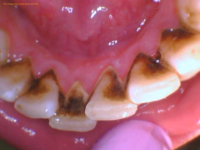 All The Different Types Of Teeth Stains - 1311 Jackson Ave Dental ...