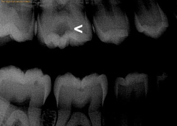 mild cavity