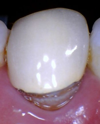 Is It Possible To Get Tooth Decay Under A Crown With Root Canal? - 1311 ...