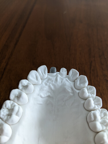 Root Canal Tooth Broke Off At Gum Line: Treatment Options - 1311 ...