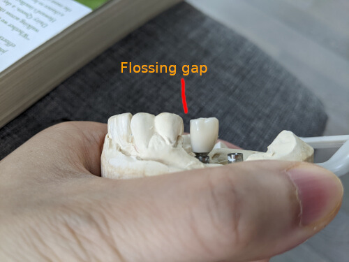 Signs & Symptoms of a Bad Fitting Crown - 1311 Jackson Ave Dental ...