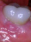 Abscess Is Still There After The Root Canal: What To Do? - 1311 Jackson ...