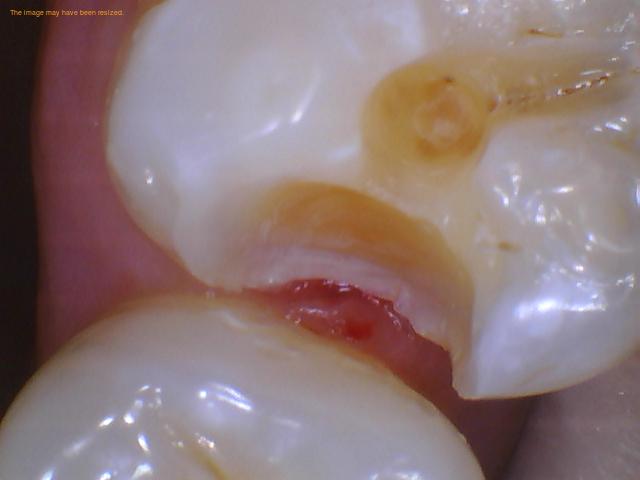 1 surface filling vs 2 surface filling: Differences - 1311 Jackson Ave ...