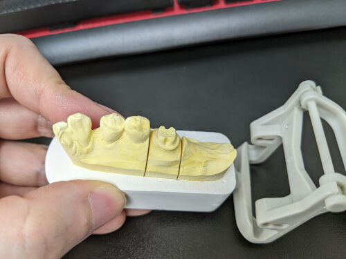 My Zirconia Crown Keeps Coming Off - 1311 Jackson Ave Dental | Dentist ...