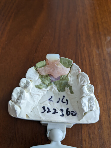 Wearing a Flipper Tooth With a Healing Abutment - 1311 Jackson Ave ...