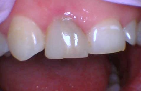 Why Dead Teeth Change Color - 1311 Jackson Ave Dental | Dentist in Long ...