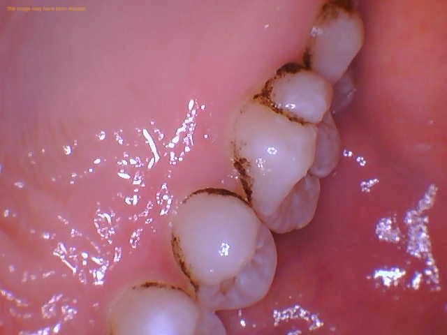 All The Different Types Of Teeth Stains - 1311 Jackson Ave Dental ...