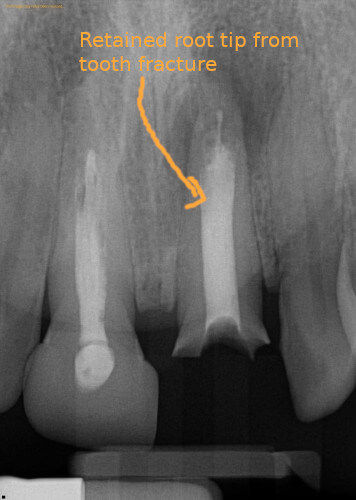 Are Retained Root Tips a Problem? - 1311 Jackson Ave Dental | Dentist ...