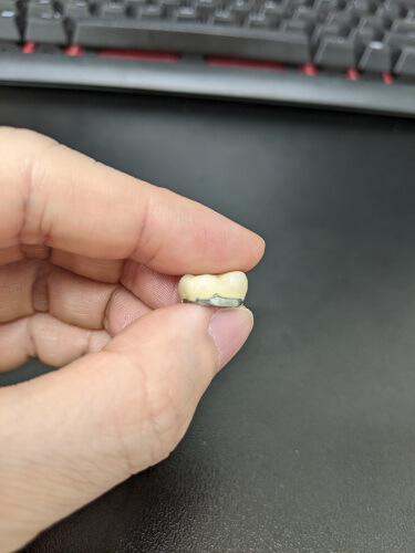 Porcelain Fused To Metal Crowns (PFM): Things To Know - 1311 Jackson ...