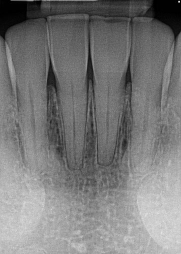 Dental X-rays: Things To Know - 1311 Jackson Ave Dental | Dentist in ...