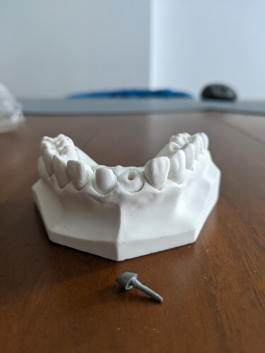 Root Canal Tooth Broke Off At Gum Line: Treatment Options - 1311 ...