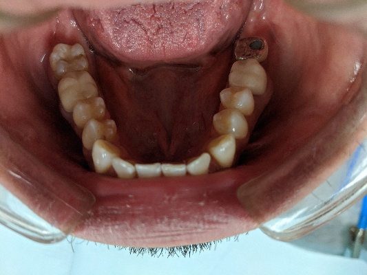 How Many Teeth CAN Humans Have? - 1311 Jackson Ave Dental | Dentist in ...