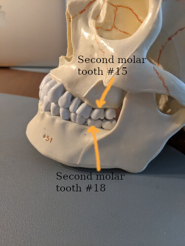 Is Second Molar Replacement Absolutely Necessary? - 1311 Jackson Ave ...