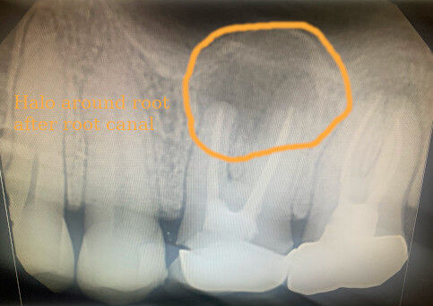 Abscess Is Still There After The Root Canal: What To Do? - 1311 Jackson ...