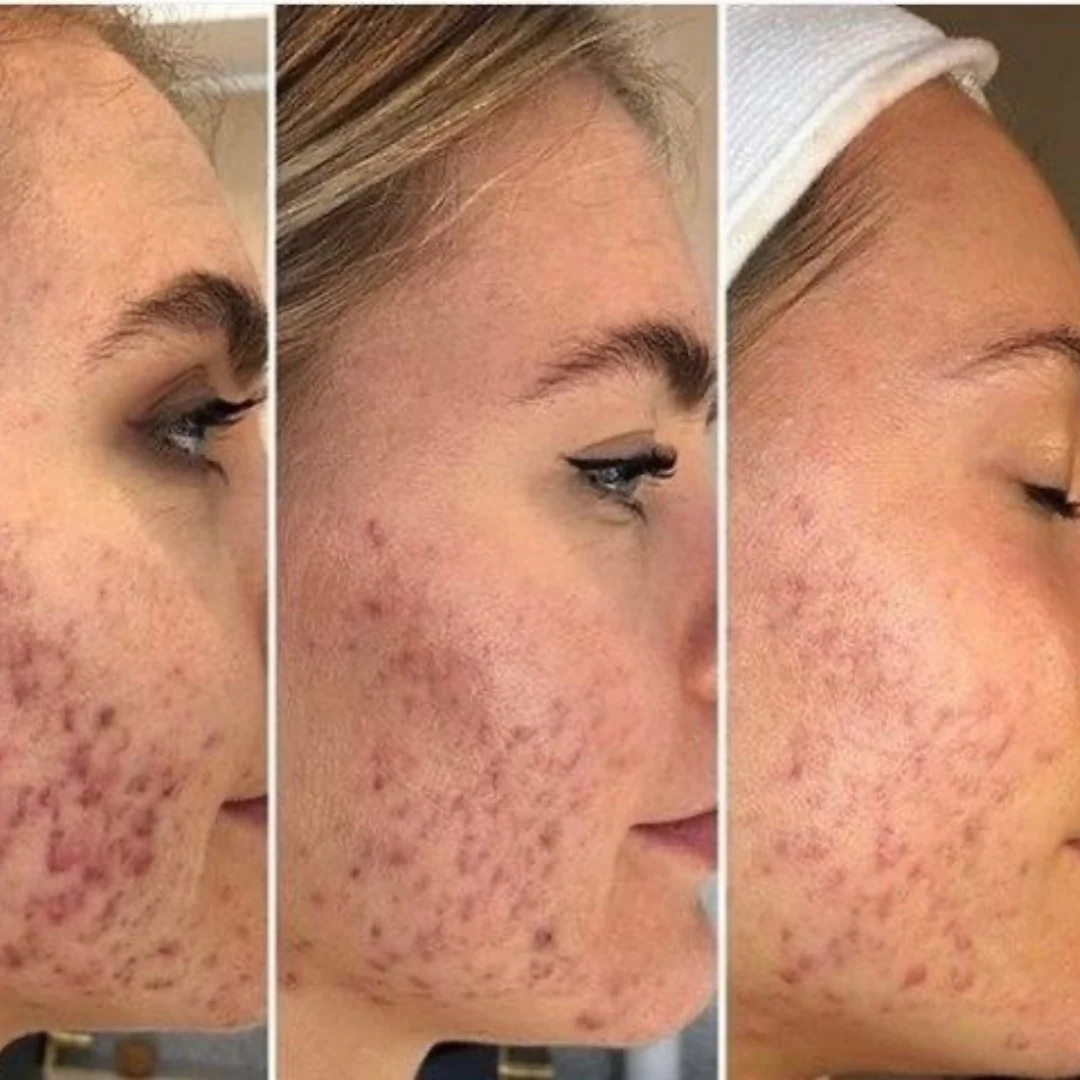 Skin tightening fractional gold rf microneedle machine | STARLIGHT PHARMACY