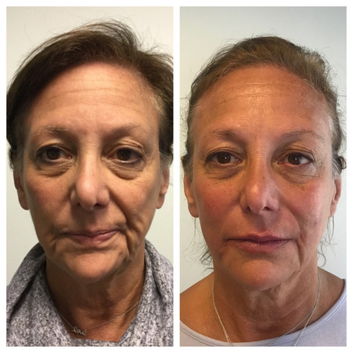 Patient Before After | The Confidence Bar | Medical Spa