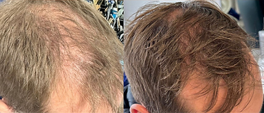 PRF Hair Restoration