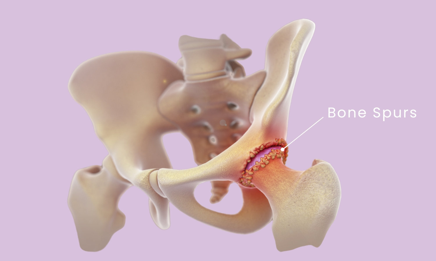 Understanding Bone Spurs in the Hip: Causes, Symptoms, and Treatment ...