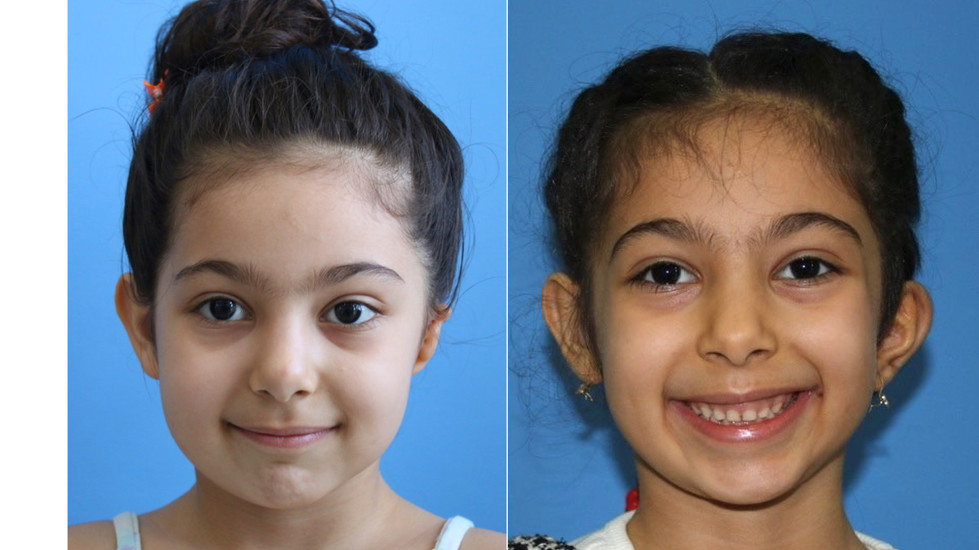 Microtia Treatment | Microtia Clinic | Muğla