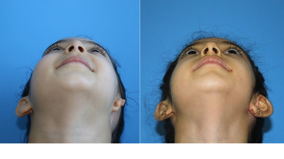 Microtia Treatment | Microtia Clinic | Muğla
