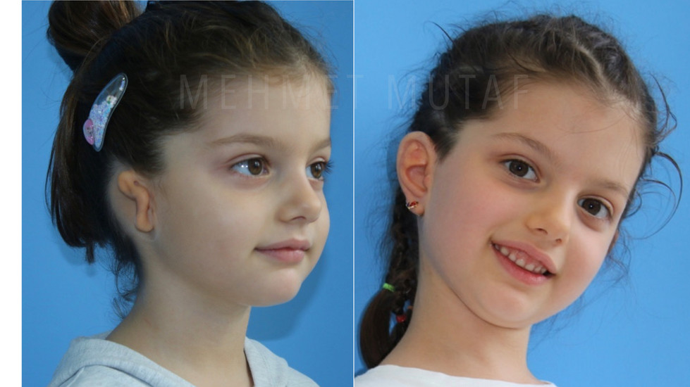 Microtia Treatment | Microtia Clinic | Muğla