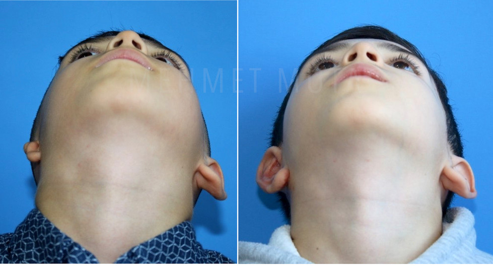 Microtia Treatment | Microtia Clinic | Muğla