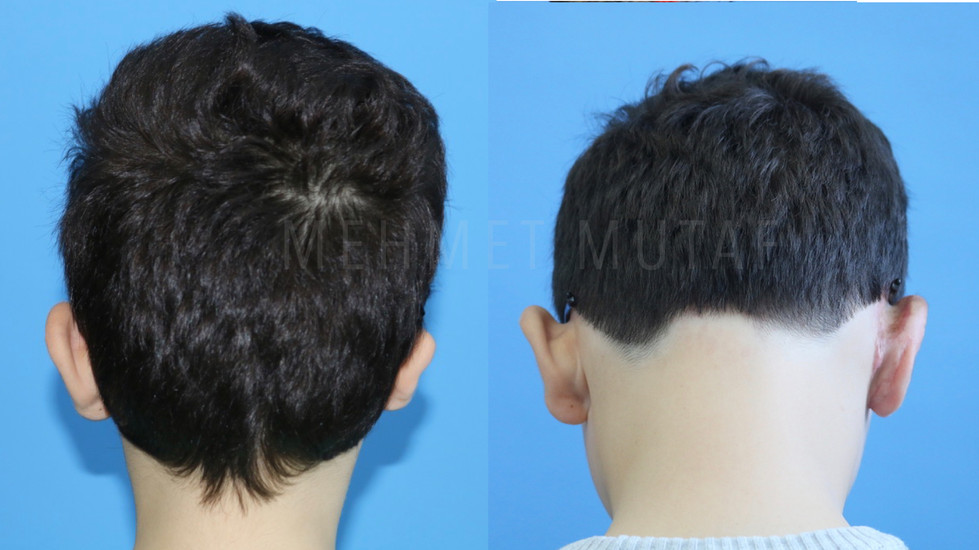 Microtia Treatment | Microtia Clinic | Muğla
