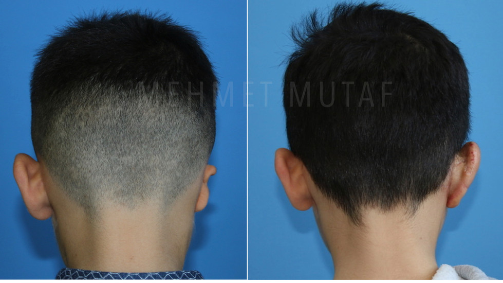 Microtia Treatment | Microtia Clinic | Muğla